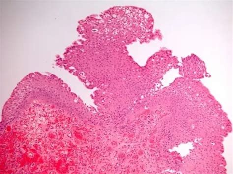 What Is Polypoid Cystitis Pathosomes