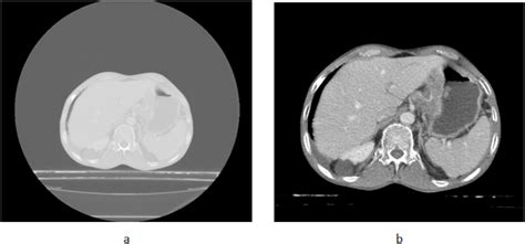 Deep Learning Based Automated Liver Contouring Using A Small Sample Of