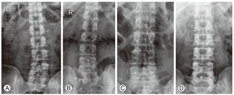 Lumbosacral Transition Vertebra Prevalence And Its Significance Pmc
