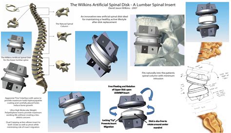 Spinal Insert By David Wilkins At Spinal Insert By David Wilkins At