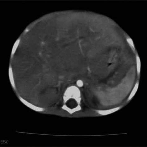 Marked Enlargement Of The Liver With Diffuse Hypodense Areas CT Abdomen Download Scientific