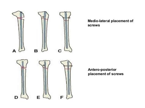 Poller Or Blocking Screw