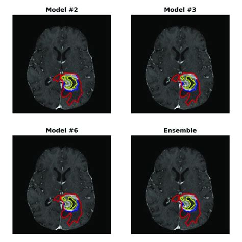 Pdf Brain Tumor Segmentation Using An Ensemble Of 3d U Nets And
