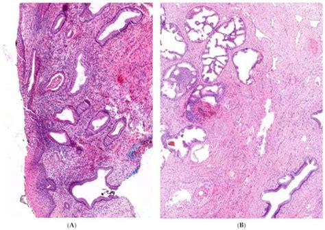 Congenital Adrenal Hyperplasia Histology