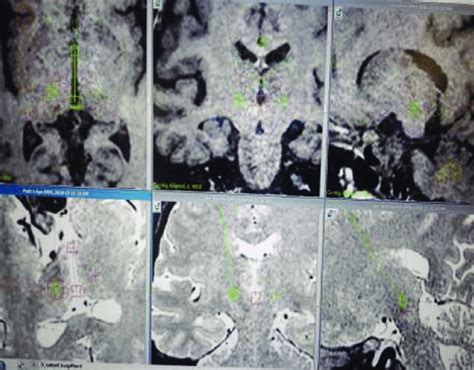 Coordinates For Right Ventral Intermediate Nucleus Thalamic Deep Brain Download Scientific