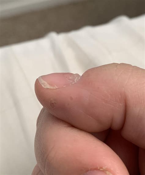 Sobbing My Nails Have Never Been Affected This Bad Rdyshidrosis