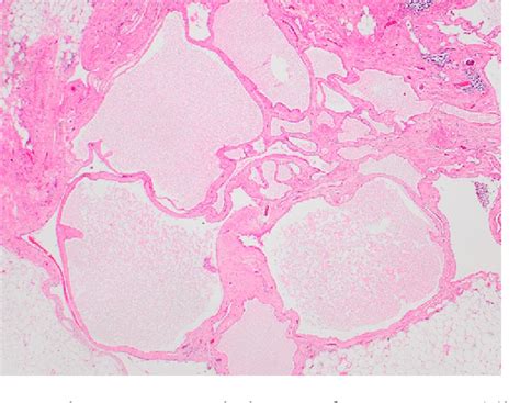 Figure 1 From New Insights In The Pathology Of Peritoneal Surface