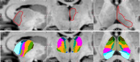 Thalamicnuclei Free Surfer Wiki