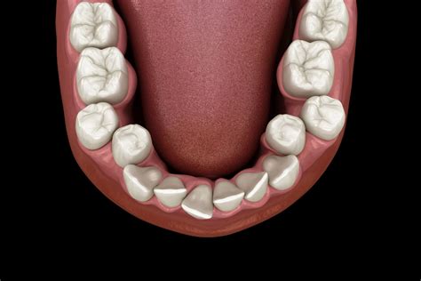 Understanding Dental Cross Bite Causes Effects And Treatments The