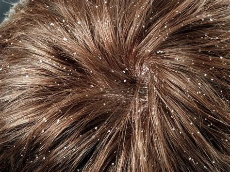 Причины появления перхоти на голове у женщин и мужчин