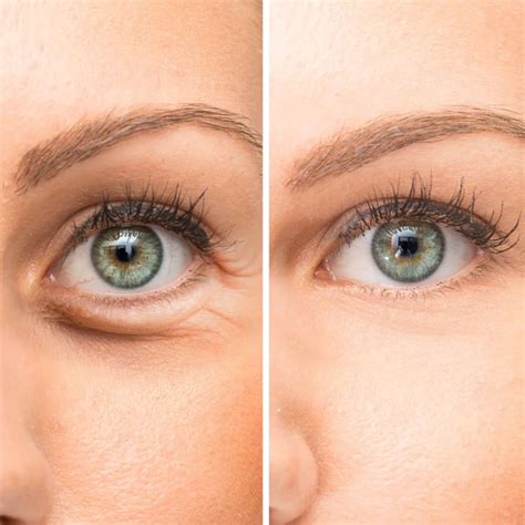 Lumin Eye Effectieve Behandeling Tegen Wallen