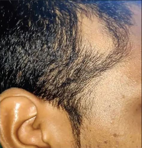 Triangular Alopecia What It Is Pictures And Treatments