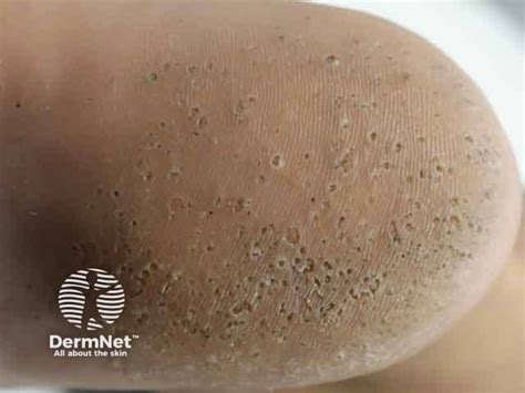 Dermnet Nz Dermnet Dermnetnz X