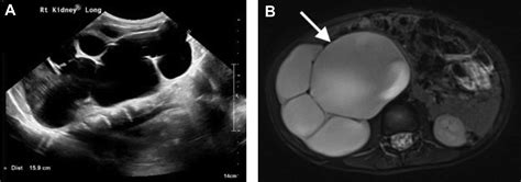 Pediatric Abdominal Masses Radiology Key
