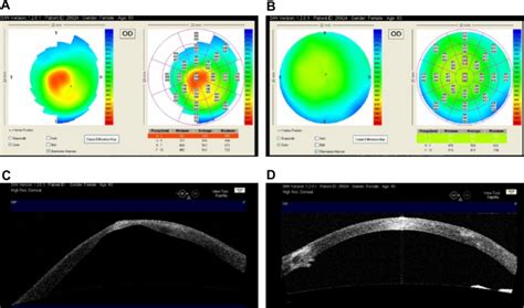 A The Preoperative Map Of A 59 Year Old Female Patient With