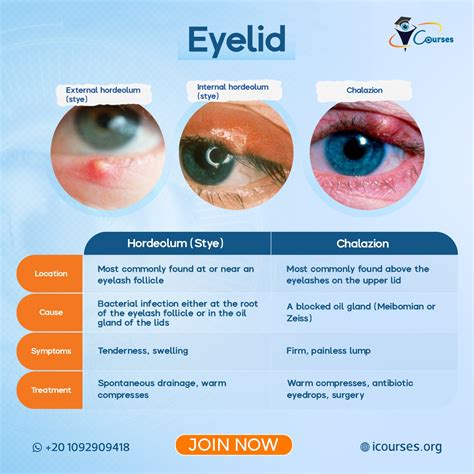 I Courses Hordeolum Vs Chalazion Key Differences 👁️🔍 Facebook