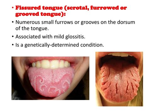 Ppt Gi 01 Diseases Of The Oral Cavity Powerpoint Presentation Free