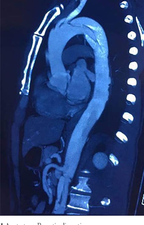 Figure 1 From Aortic Intimal Intussusception During Acute Type B Aortic Dissection Endovascular