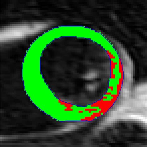 The Example Lge Slices From Figure 1 With Identified Scar Red And Download Scientific Diagram