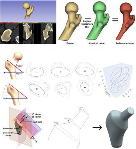 A Segmentation Of The Right Femur Using 3d Slicer® B Femoral