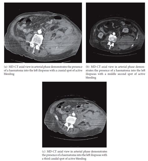 Endovascular Embolization Of Spontaneous Iliopsoas Hematoma First Experience With Squidperi Pmc