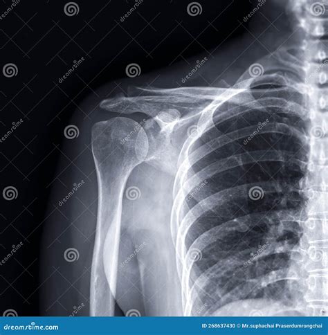 X Ray Shoulder Joint Shoulder Front View For Diagnosis Fracture Of