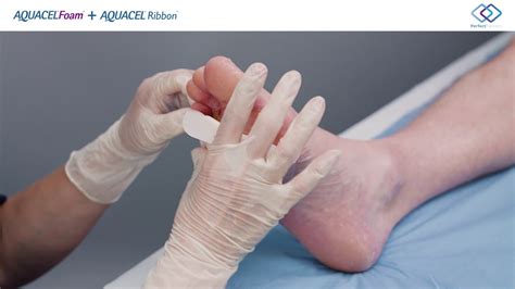 Best Dressings For Diabetic Foot Ulcers At Phillip Dorsey Blog