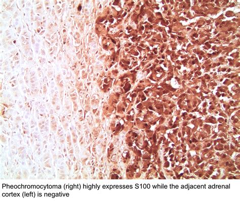 Pathology Outlines Pheochromocytoma