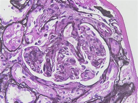 Diffuse Proliferative Glomerulonephritis Em