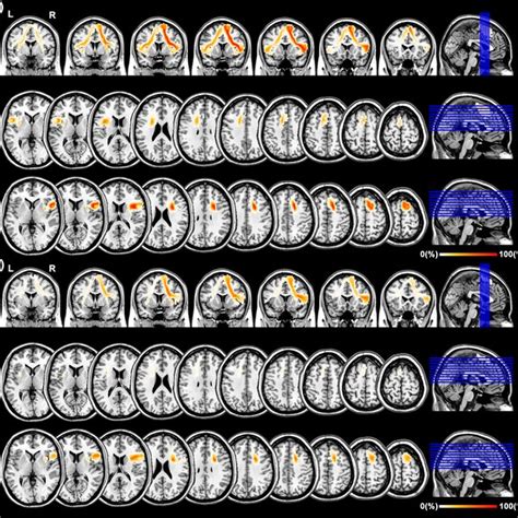 Spatial Distribution Of The Salience Network As Identified By Download Scientific Diagram
