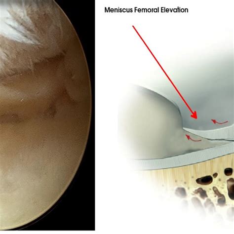 Pdf The Optimal Placement Of Sutures In All Inside Repair Of Meniscocapsular Separation