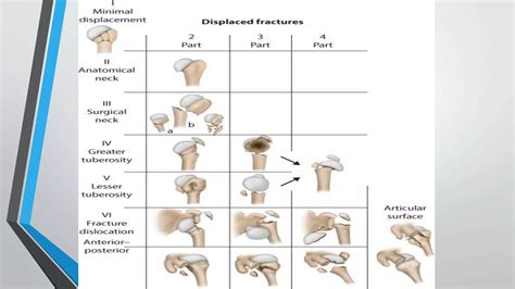 Comparative Study Of ORIF With Philos Plate Vs CRIF With K Wiring Of Neers Part And Part