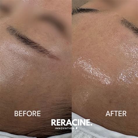 울산피부관리 리페어에스테틱 대표원장 한 유주 발라서 이렇게 된거 아니죠오~ 피부 진피부터 표피까지 튼튼하고 건강하게 피부가 민감하신분들부터 모공 요철 잔주름