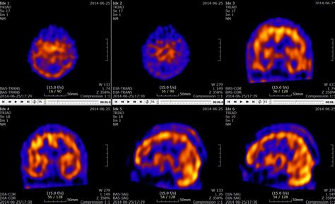 What Does A Spect Scan Measure At Jack Marshall Blog