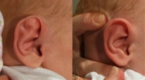 Ear Molding Dr Jill Tomlinson