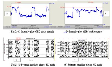 Speech Based Parkinsons Disease Detection Using Machine Learning