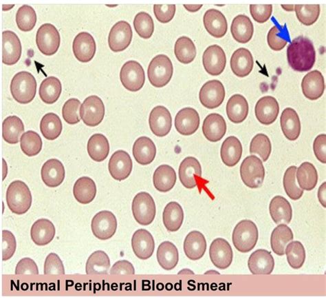 Pth Lab 3 02 Rbc And Platelet Pathology Flashcards Quizlet
