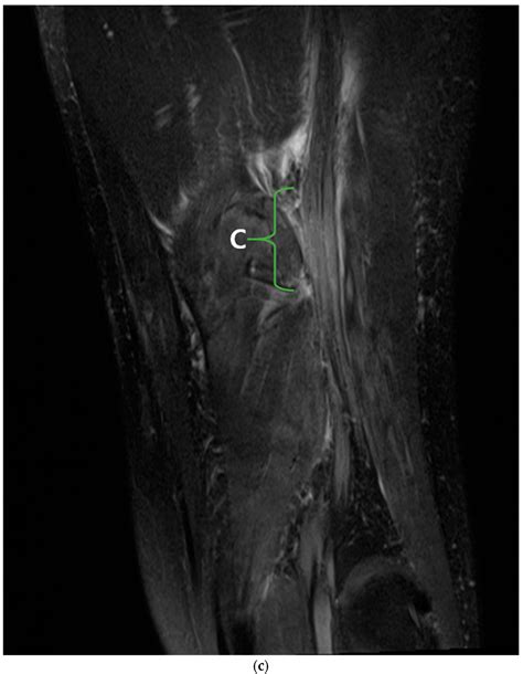 Open Sciatic Nerve Decompression For Compartment Syndrome After
