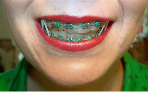 Braces Make Mouth Stick Out At Sara Swasey Blog