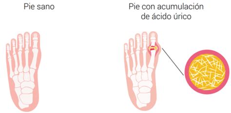 Gota Causas Síntomas Y Tratamientos Efectivos Laboratorio Bioclinic