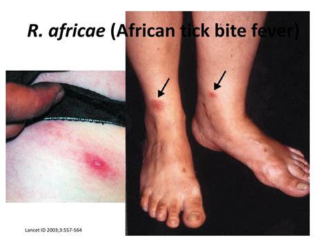 Ppt Rickettsial Diseases And Lyme Africom Focus Powerpoint Presentation Id2267908