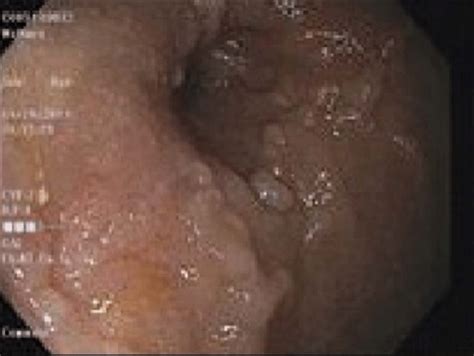 Esophagogastroduodenoscopy Revealed A High Grade Duodenal Stricture