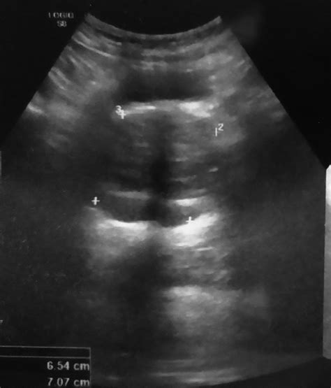 Enlarged Prostate Ultrasound