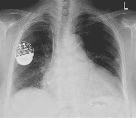 Pacemaker Buyxraysonline