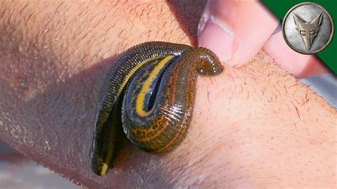 Treating Leech Bites Youtube