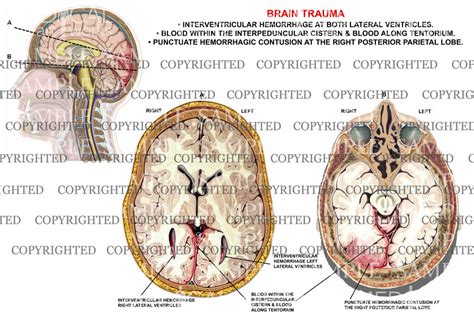 Interpeduncular Cistern Hemorrhage