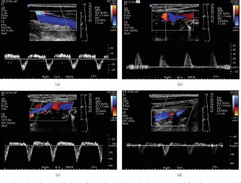 Figure 1 From Bilateral Subclavian Steal Syndrome Semantic Scholar