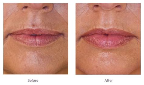 How To Stop Dry Lips After Fillers Lipstutorial Org