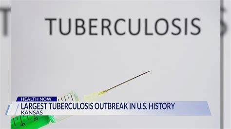 Largest Documented Tuberculosis Outbreak In Us History Hits Kansas