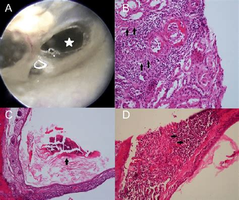 A Oto Endoscopic Image Of A Tympanic Membrane Perforation In Pars